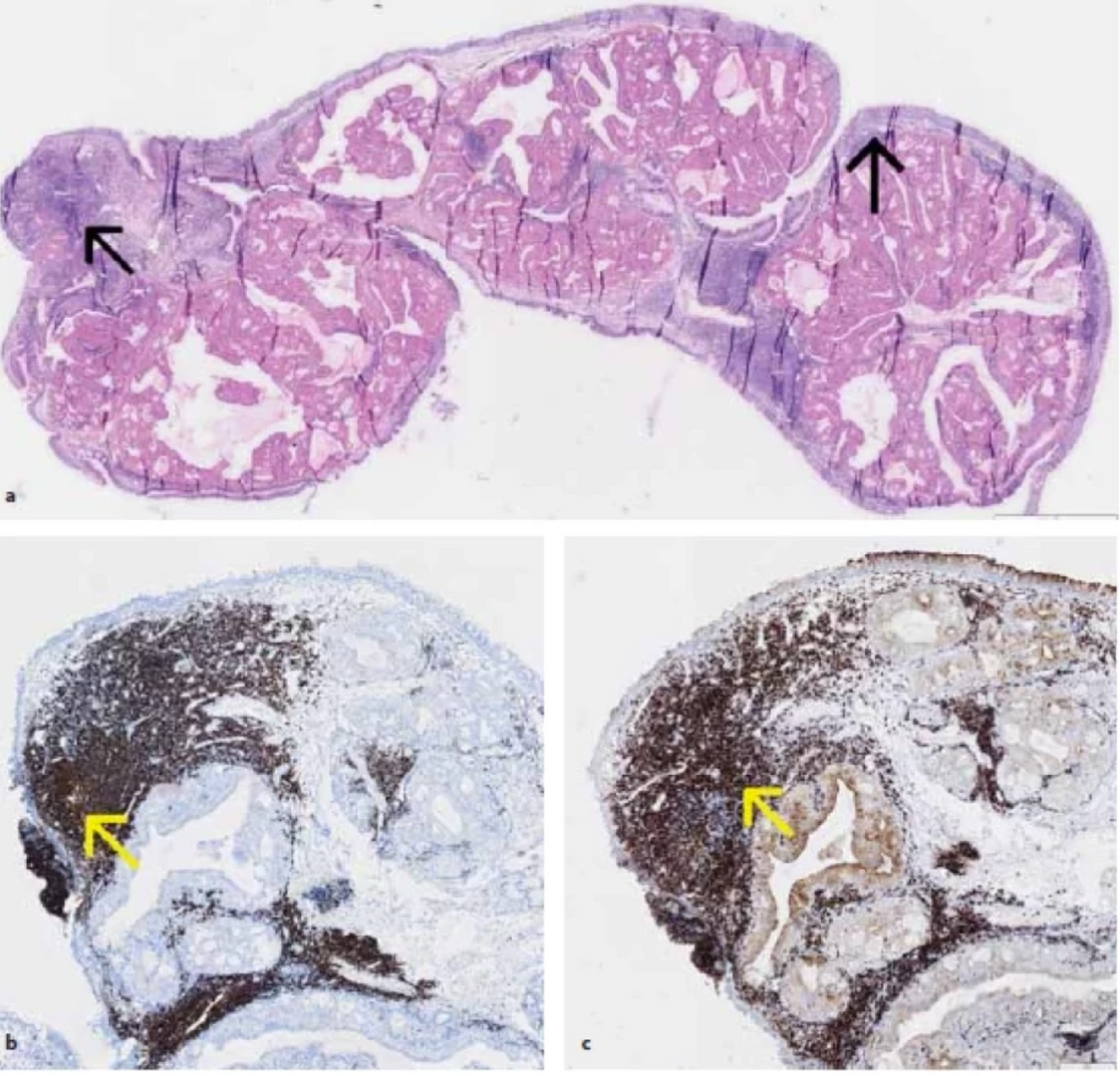 Warthin’s tumour of the nasopharynx – a case repor... | proLékaře.cz