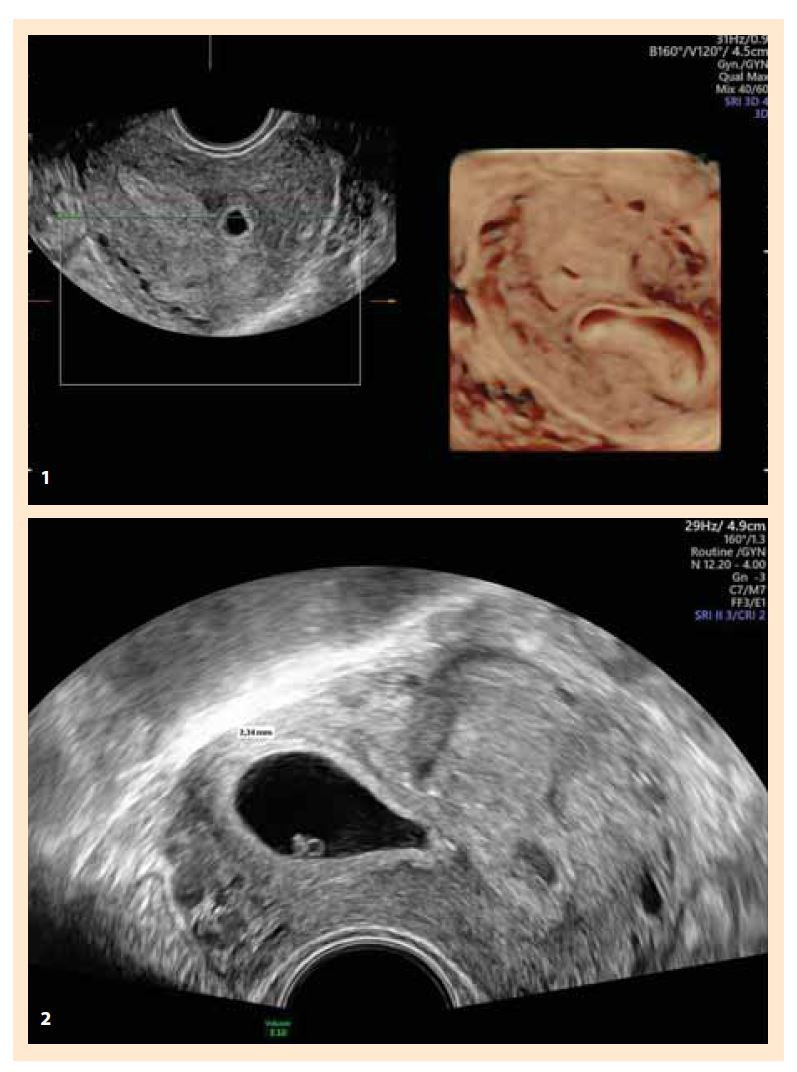 Intramyometrial pregnancy after hysteroscopic rese... | proLékaře.cz