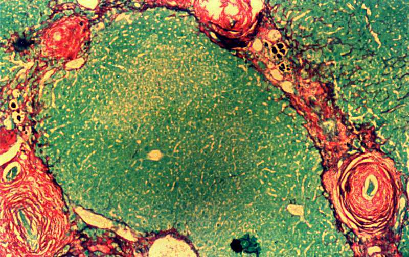 Migrace lidí a parazitů: fakta z vyšetření 5511 ci... | proLékaře.cz