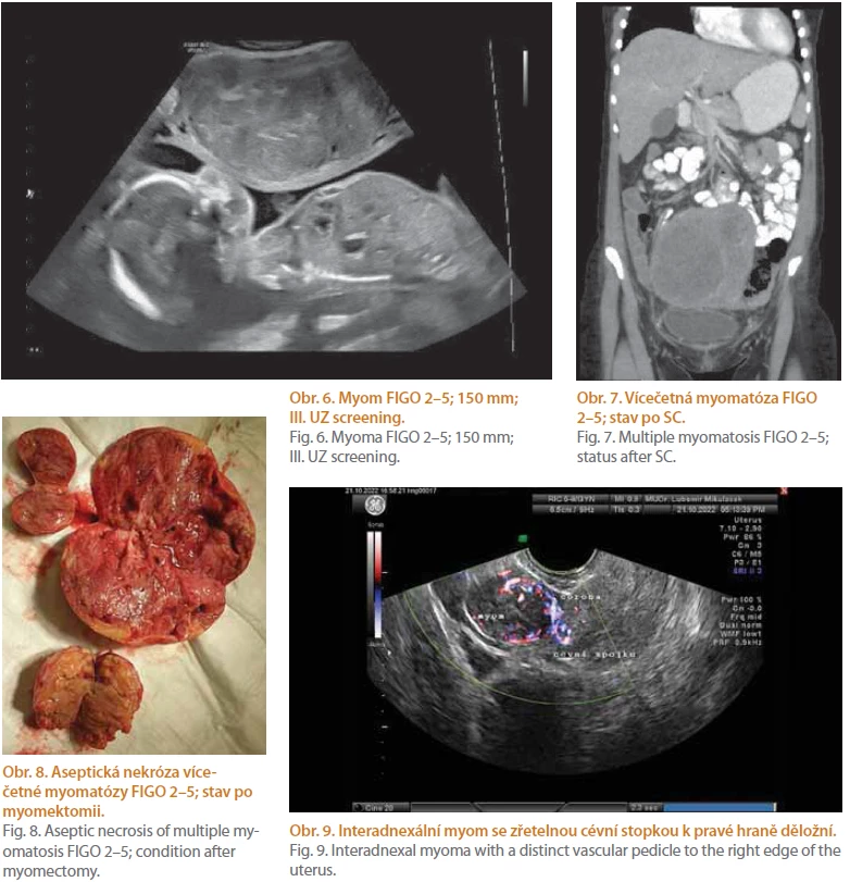 Relugolix kombinovaná terapie a symptomy děložní m... | proLékaře.cz