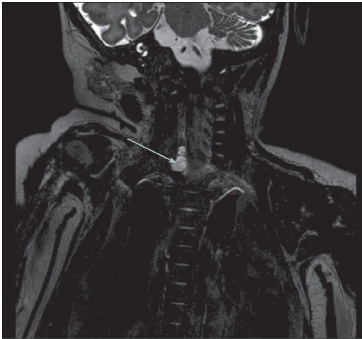 Diagnosis of root avulsion in brachial plexus inju... | proLékaře.cz