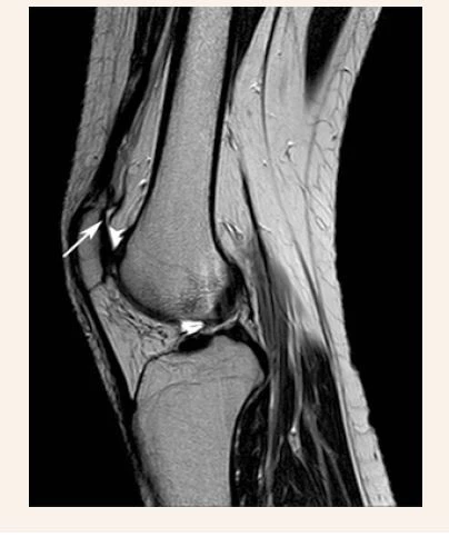 Suprapatellar plica syndrome of the knee: literatu... | proLékaře.cz