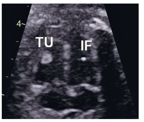 Echogenic foci in fetal heart from a pediatric car... | proLékaře.cz