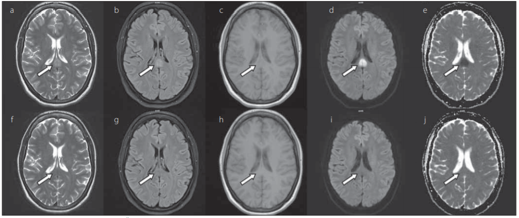 Cytotoxic lesions of the corpus callosum (CLOCCs) | proLékaře.cz