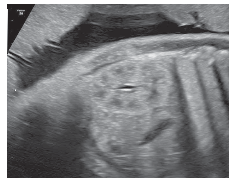 Fetal lower urinary tract obstruction: a current o... | proLékaře.cz