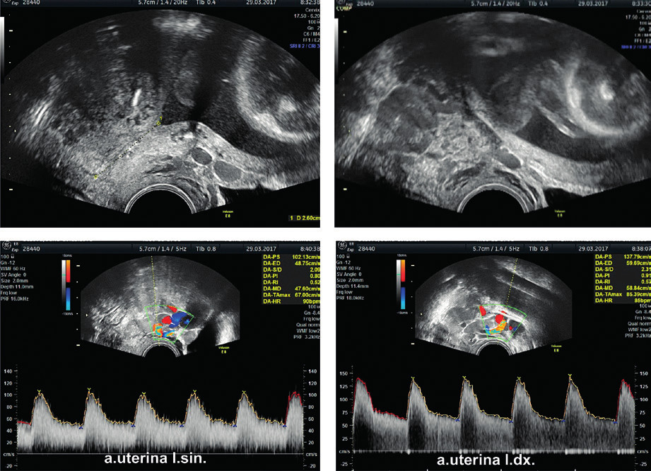 Robot assisted laparoscopic abdominal cerclage: tw... | proLékaře.cz